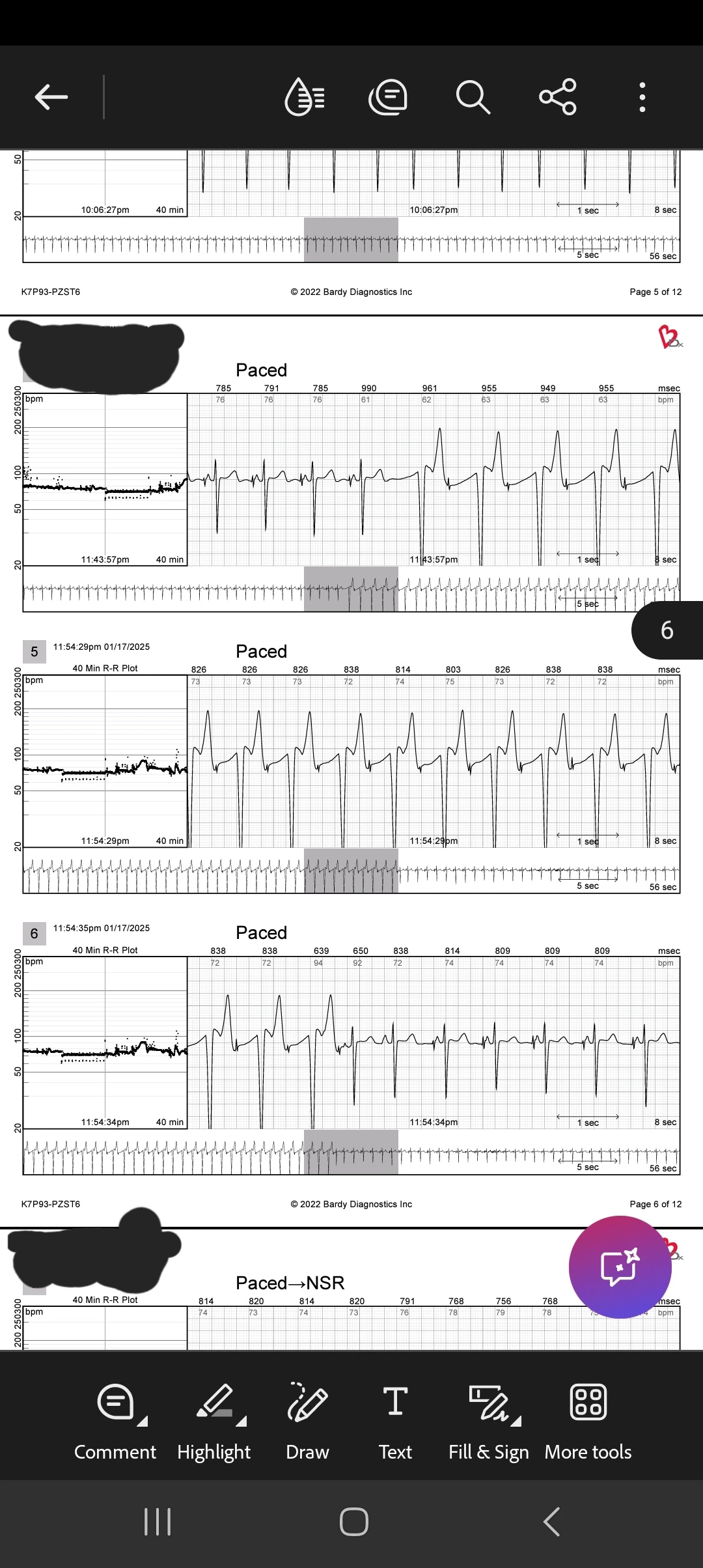 Pacemaker Club: Failure to capture..AGAIN